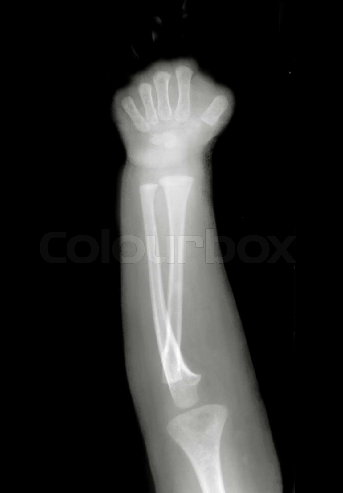 Unterarm | Stock Bild | Colourbox