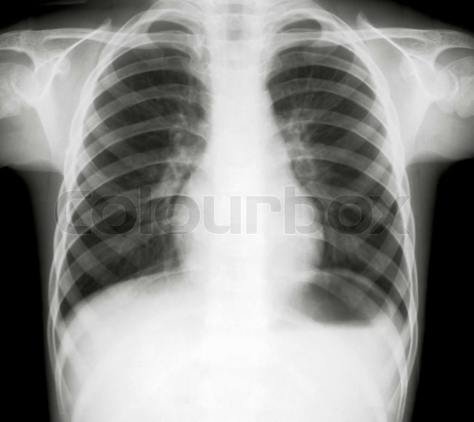 X-ray of lungs | Stock image | Colourbox
