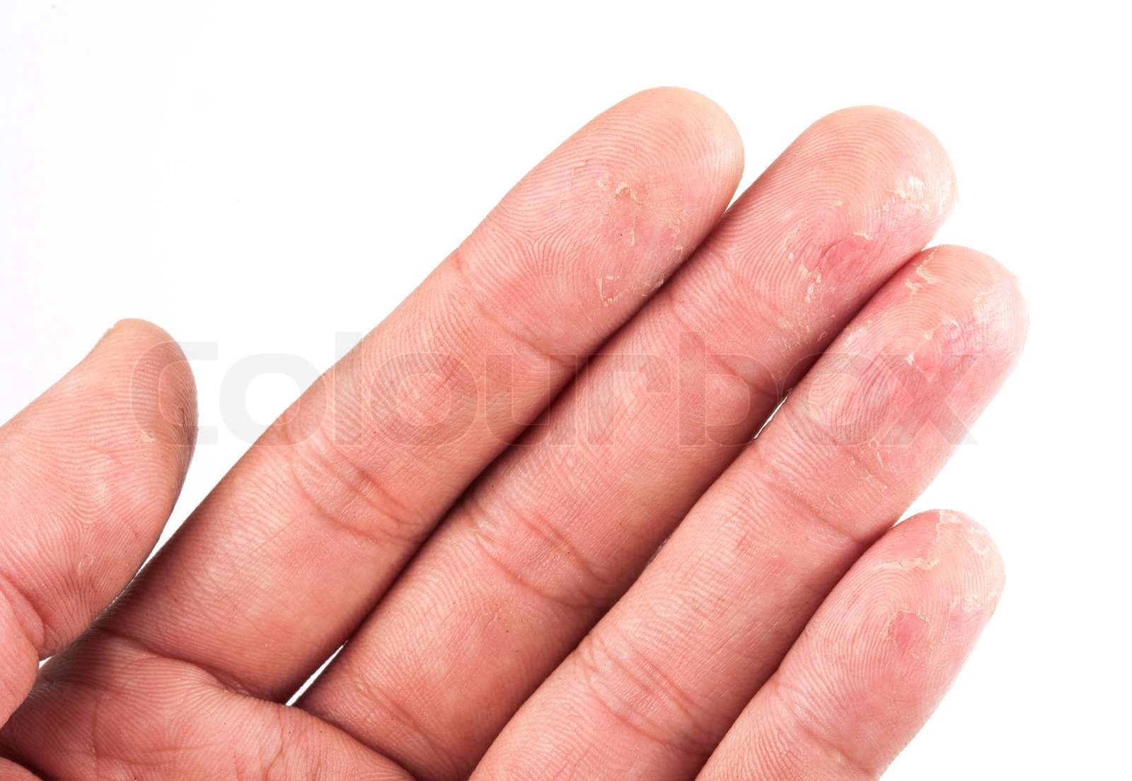 Closeup of Eczema Dermatitis on Back of Fingers | Stock image | Colourbox