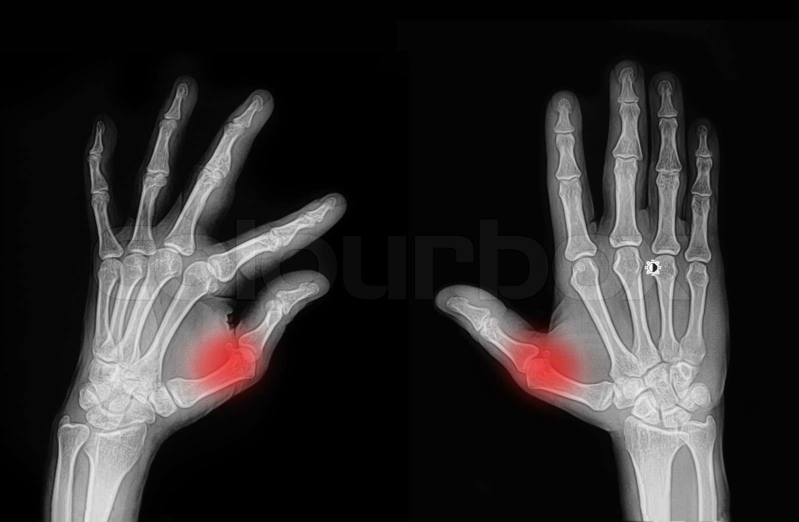 X-ray hand and finger | Stock image | Colourbox