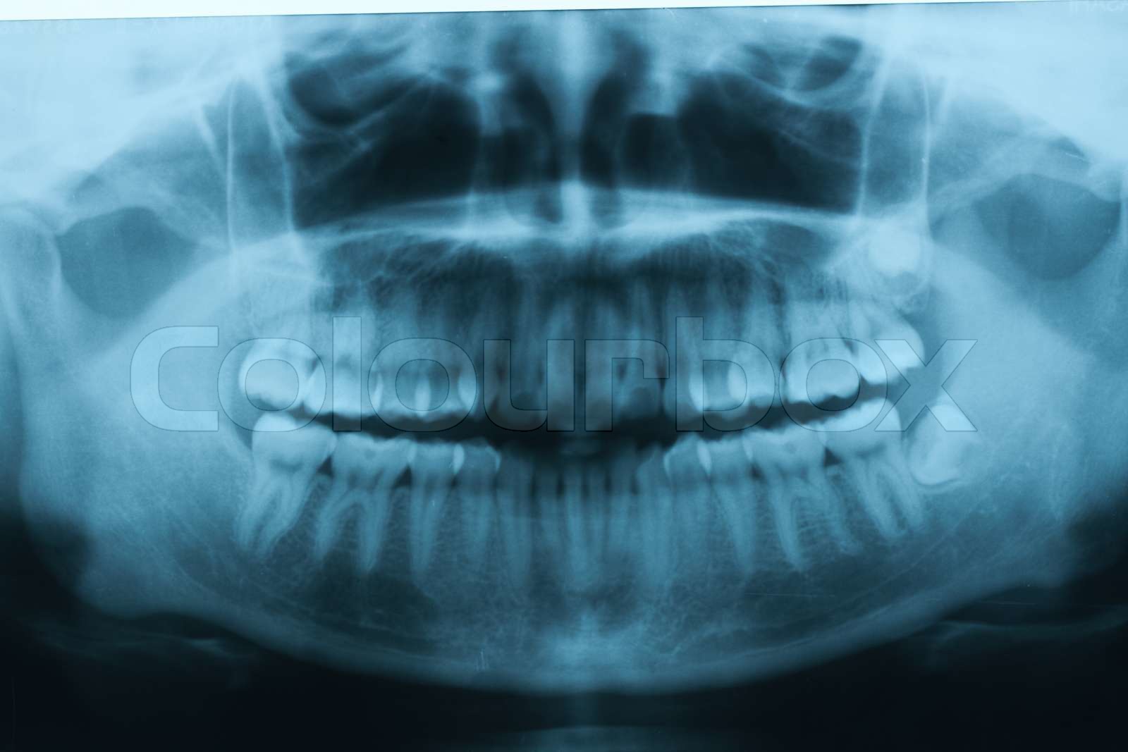 Panoramic dental X-Ray with red painful area | Stock image | Colourbox