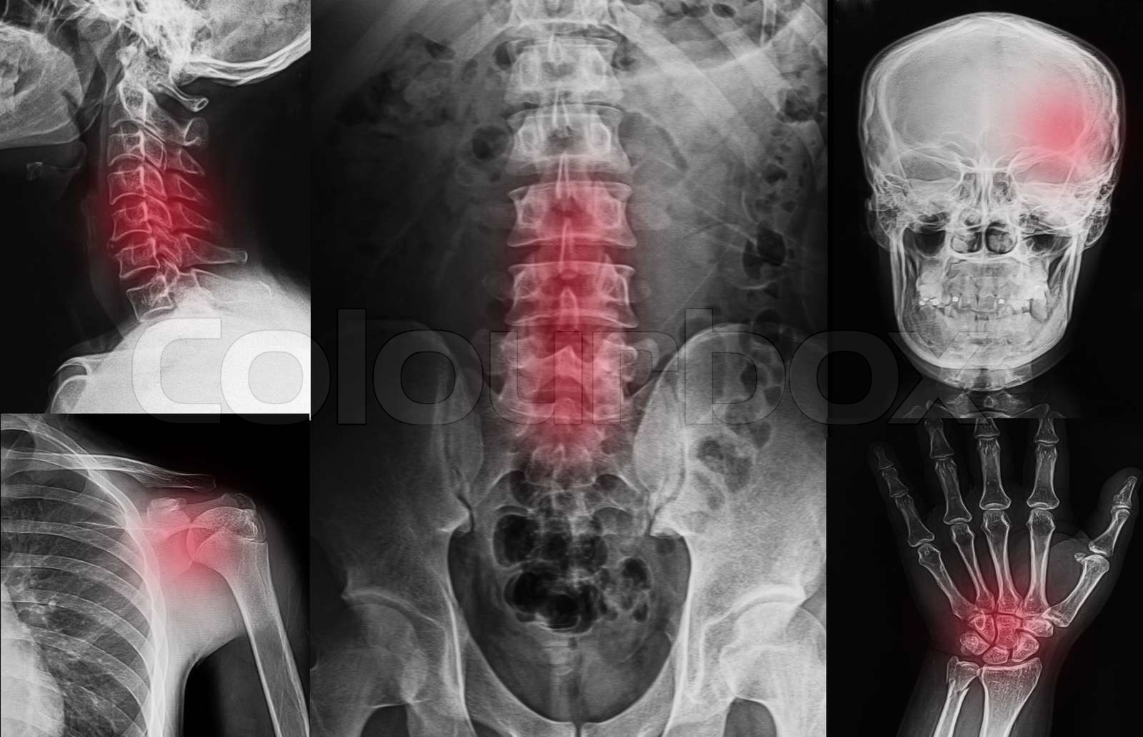 Collection x-rays image of human ,show upper extremity body part of ...