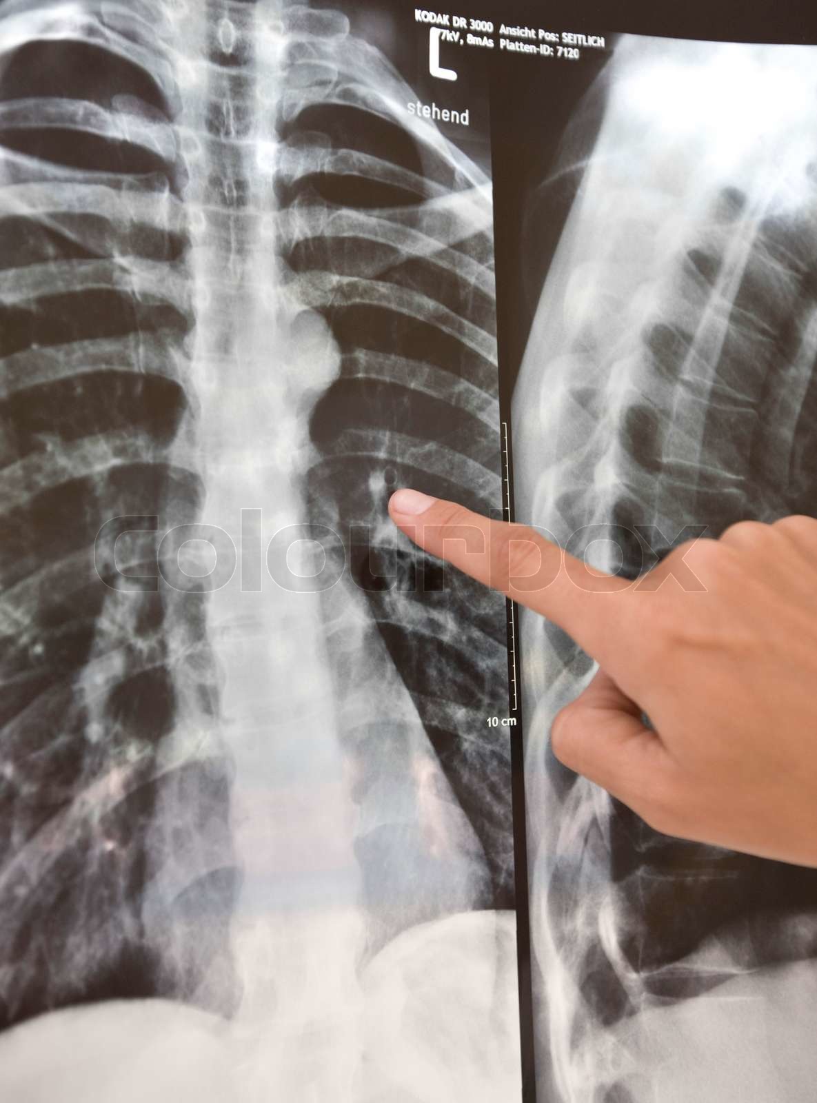 røntgenbillede, røntgen, medicinsk | Stock foto | Colourbox