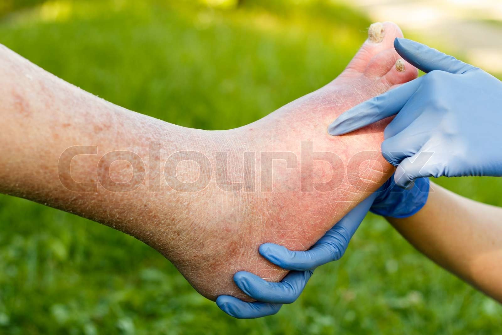 Arteriosclerotic Old Foot | Stock image | Colourbox