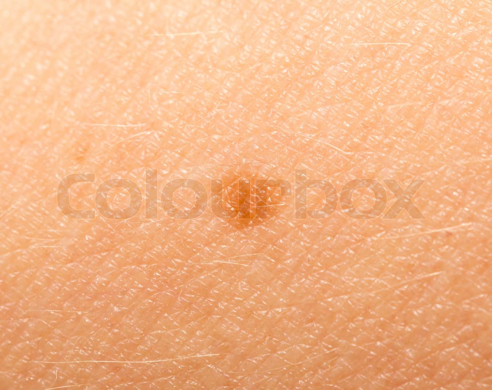 mole on the human skin | Stock image | Colourbox
