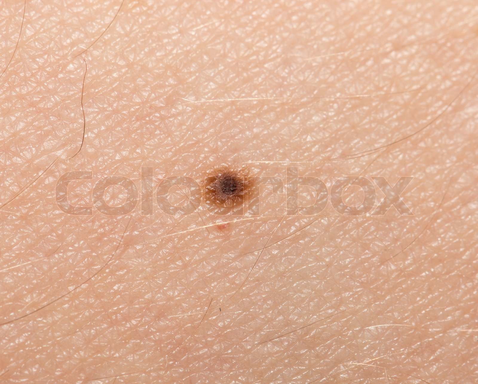 mole on the human skin | Stock image | Colourbox