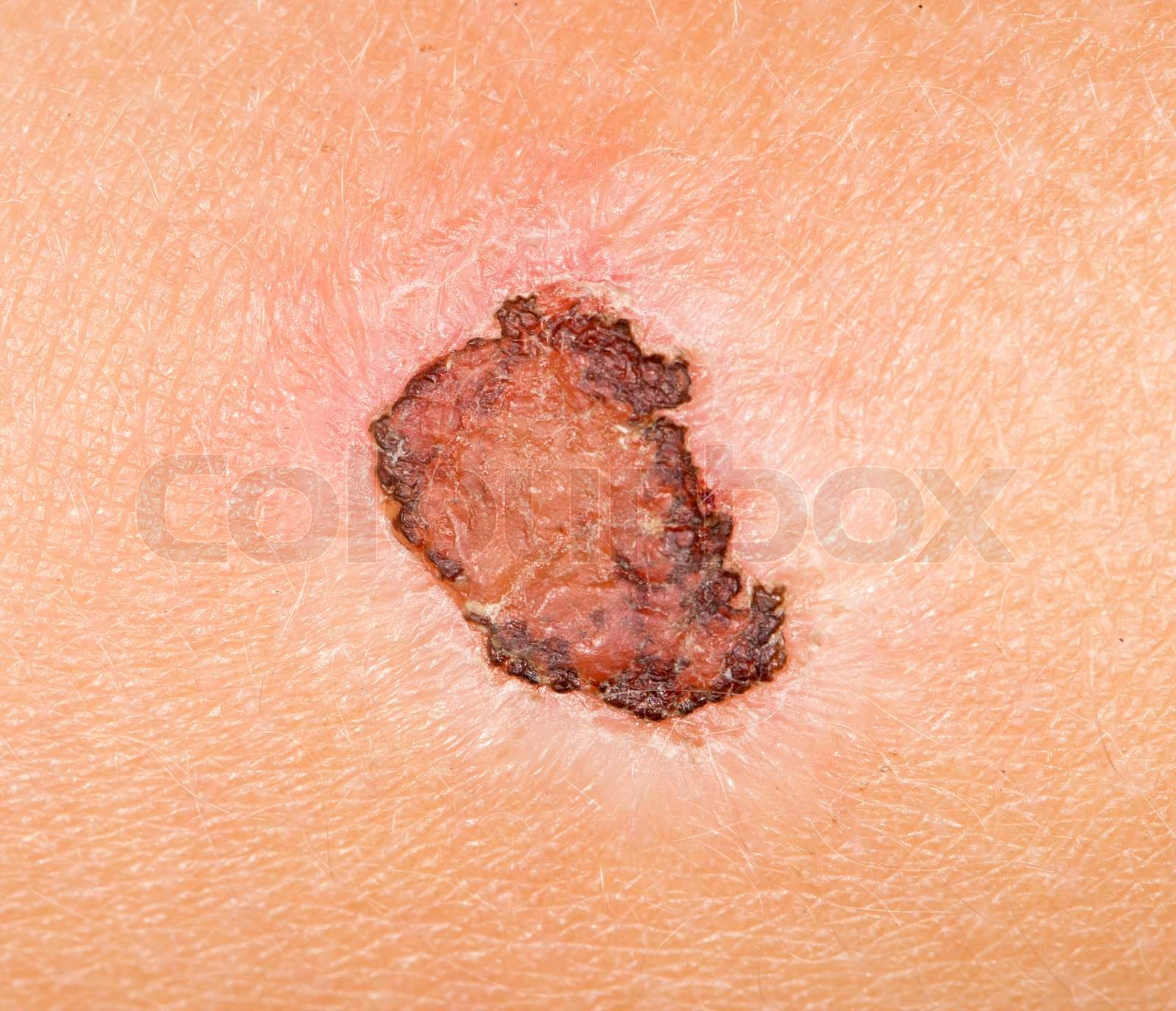 Wunde auf der menschlichen Haut. close-up | Stock Bild | Colourbox