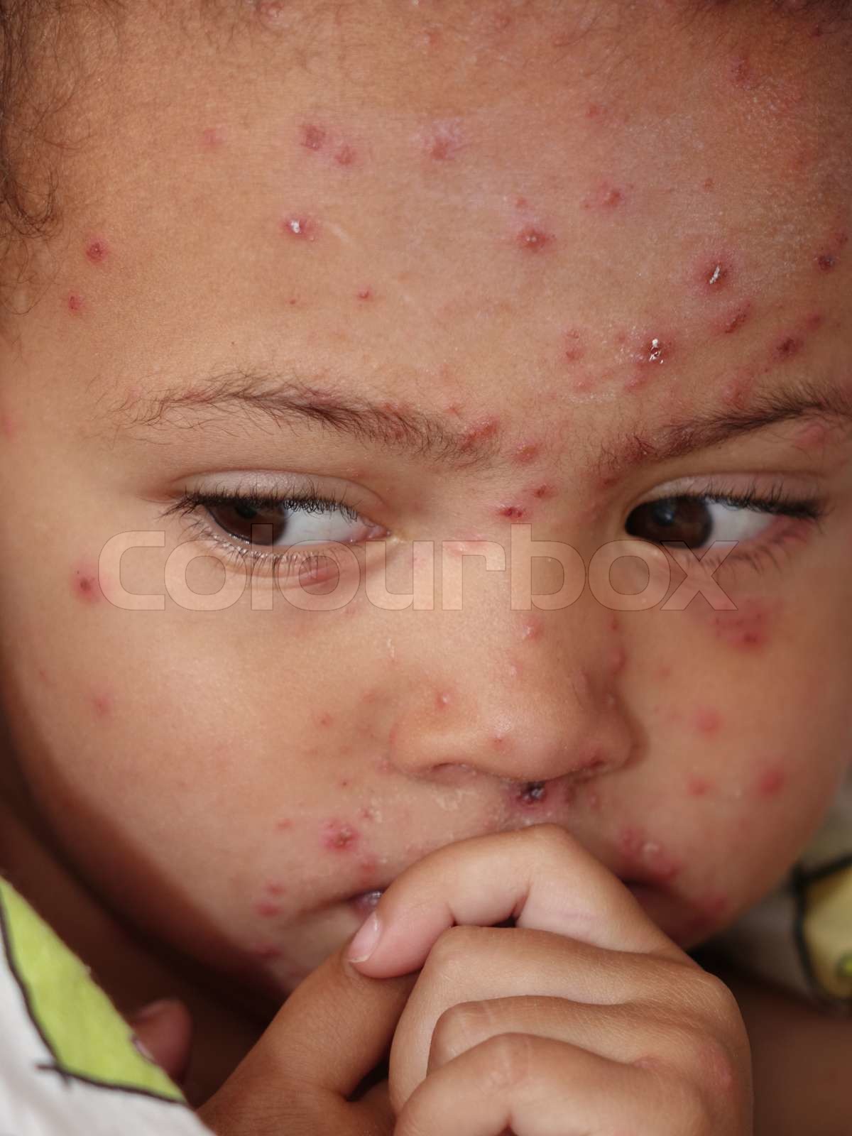 Chicken Pox On Babies Face