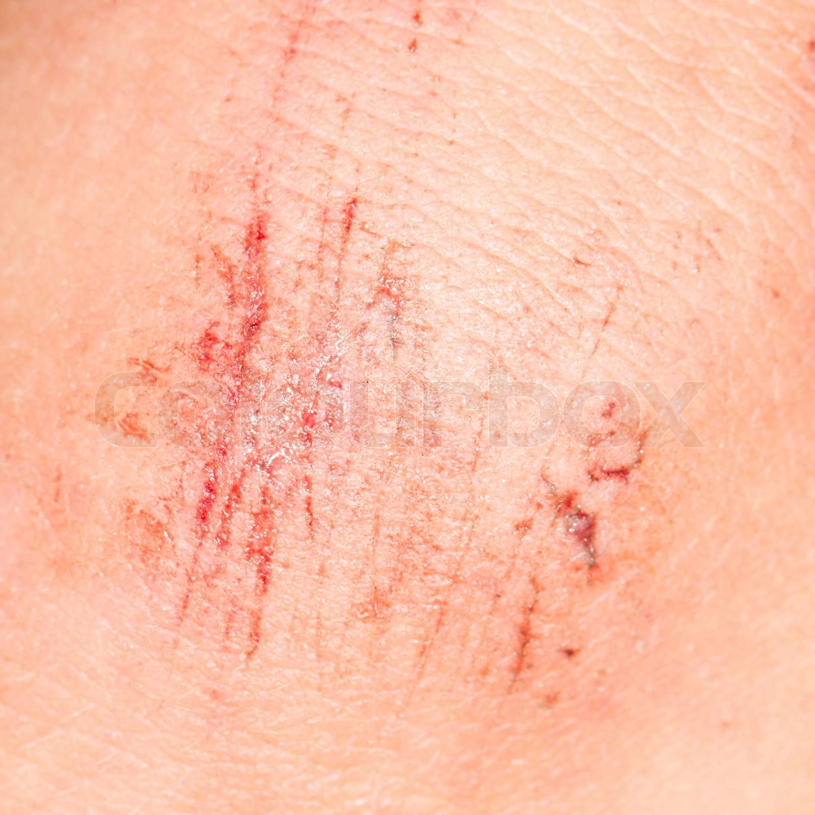 wound on the skin. close-up | Stock image | Colourbox