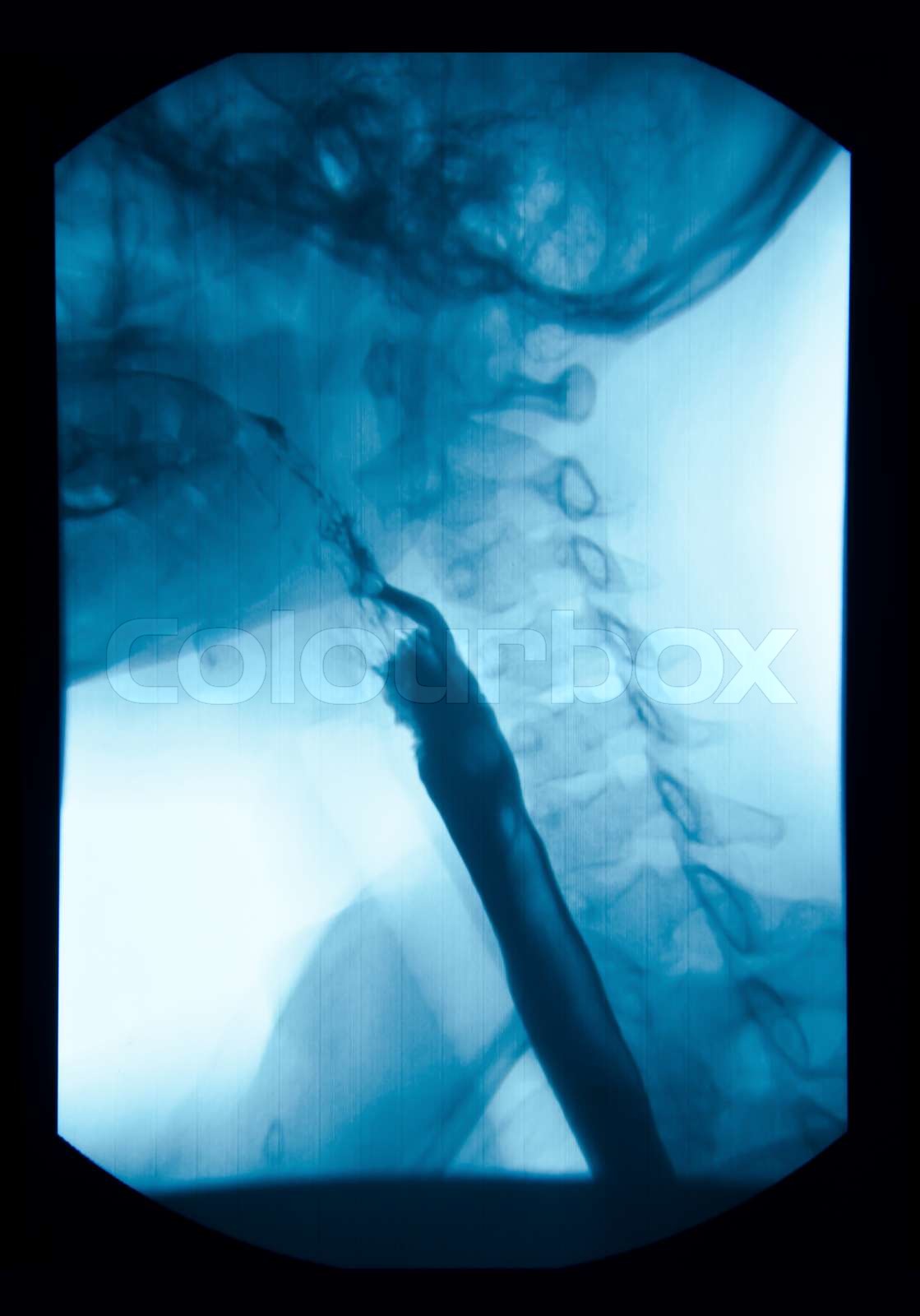 The image of x-ray upper gastrointestinal (UGI), Esophagram. | Stock ...
