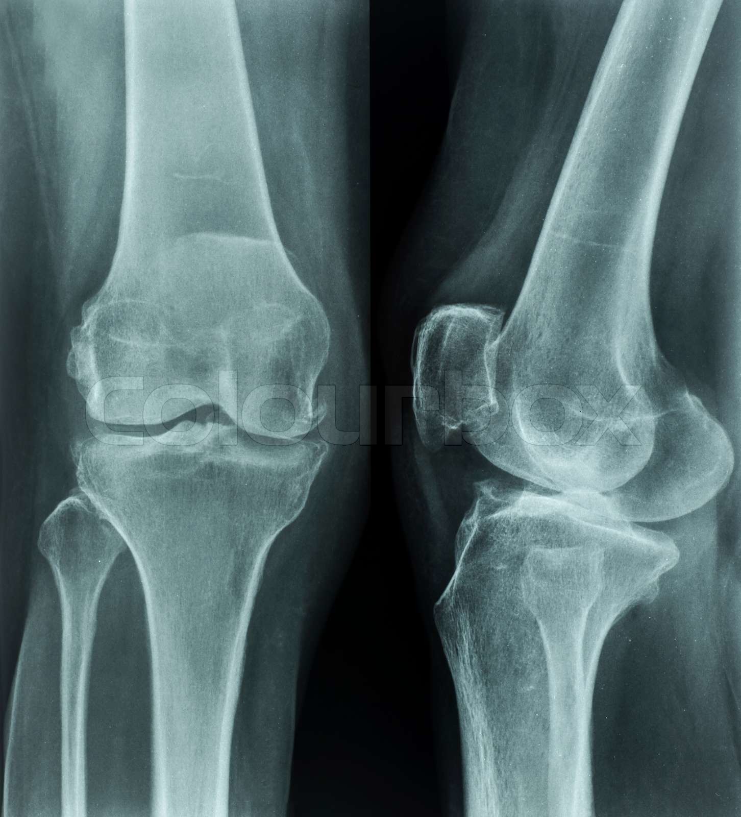 X-rays of leg | Stock image | Colourbox