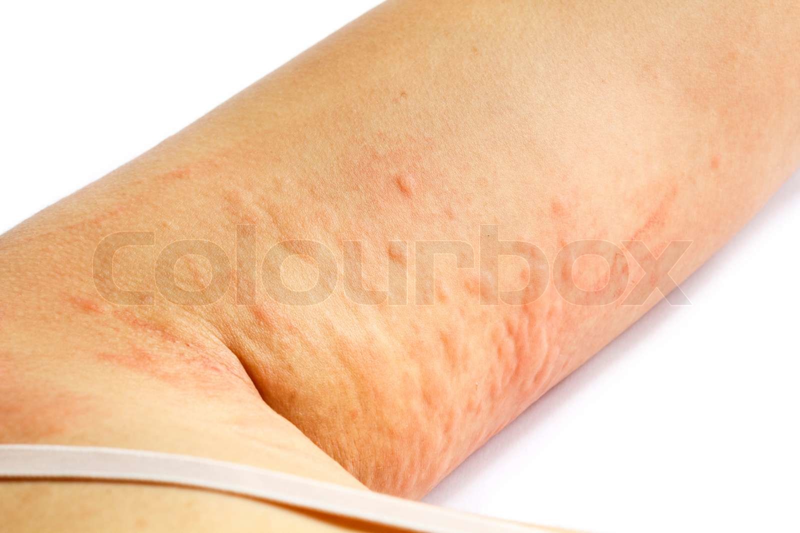 allergic rash skin of patient arm | Stock image | Colourbox