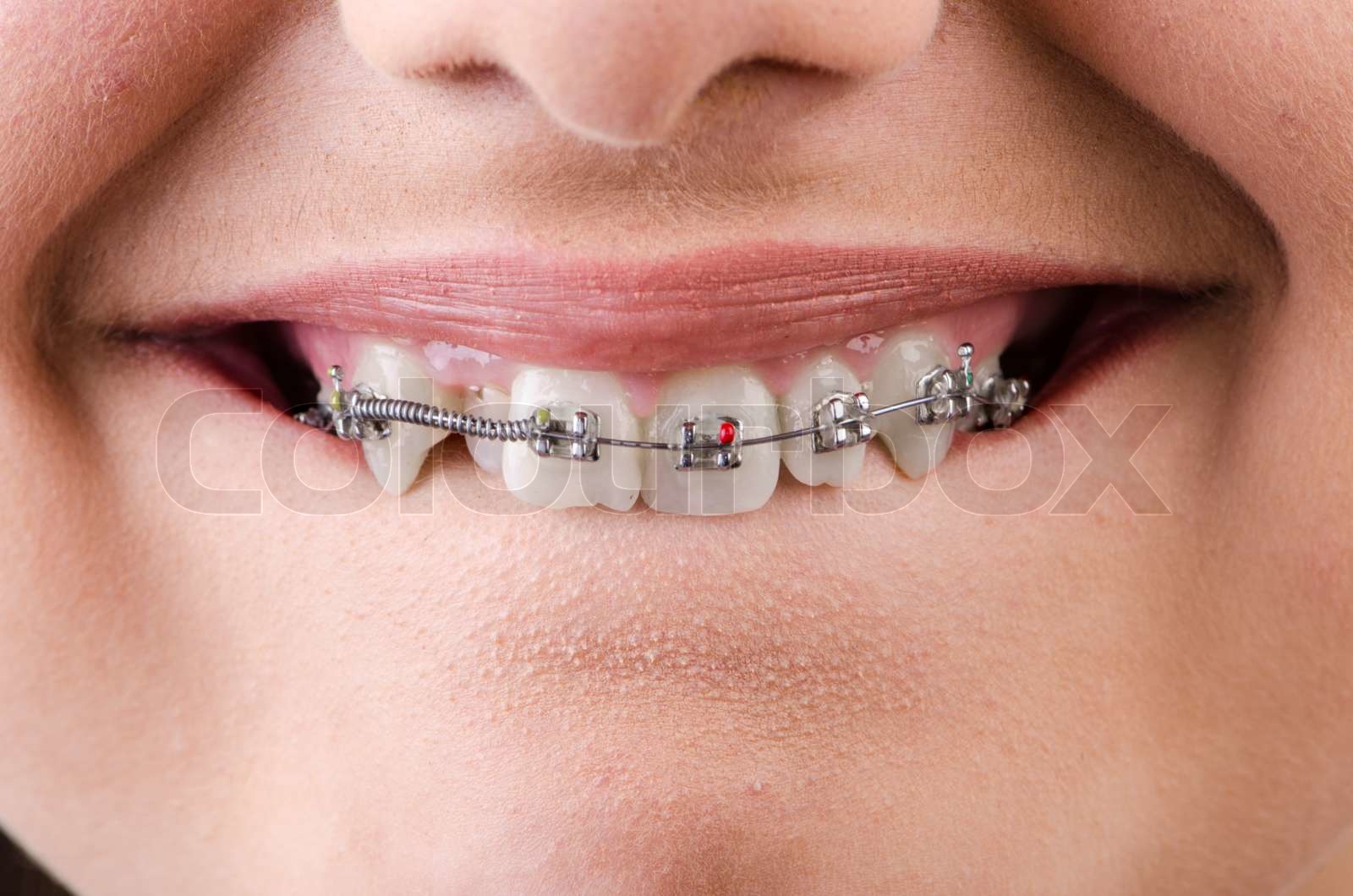 Mouth with brackets braces in medical concept | Stock image | Colourbox