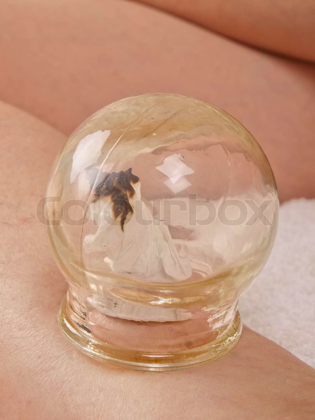 Traditional Chinese Cupping | Stock image | Colourbox