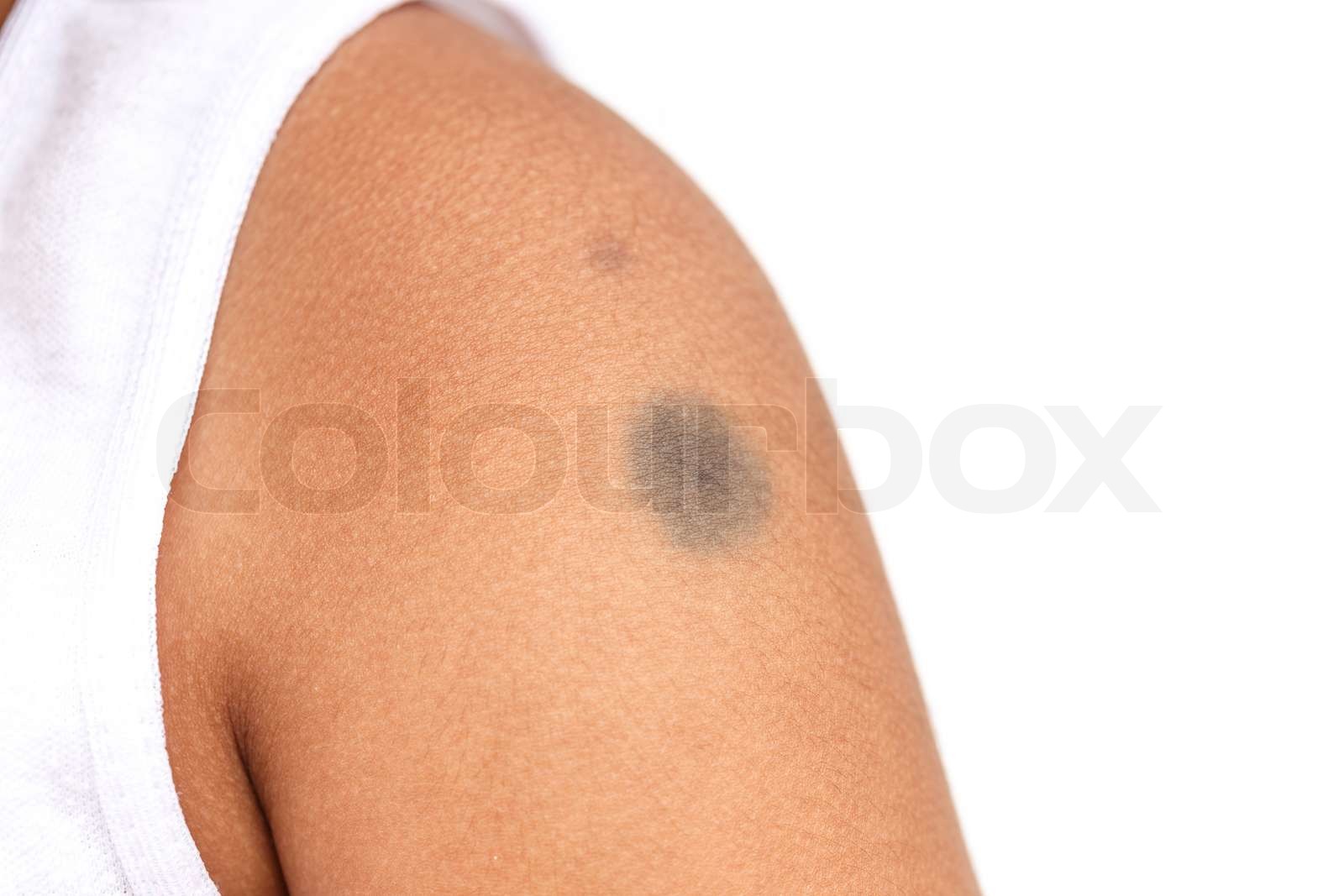 Close-up of black birthmark on skin | Stock image | Colourbox