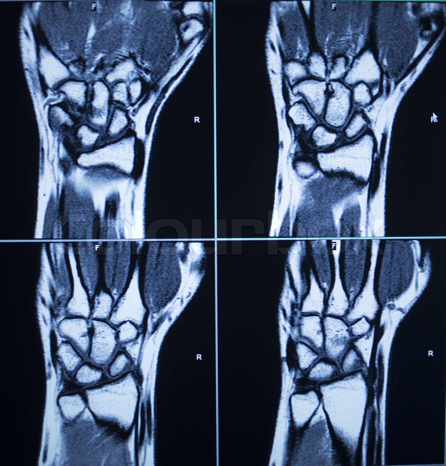 MRI scan test results wrist hand injury | Stock image | Colourbox
