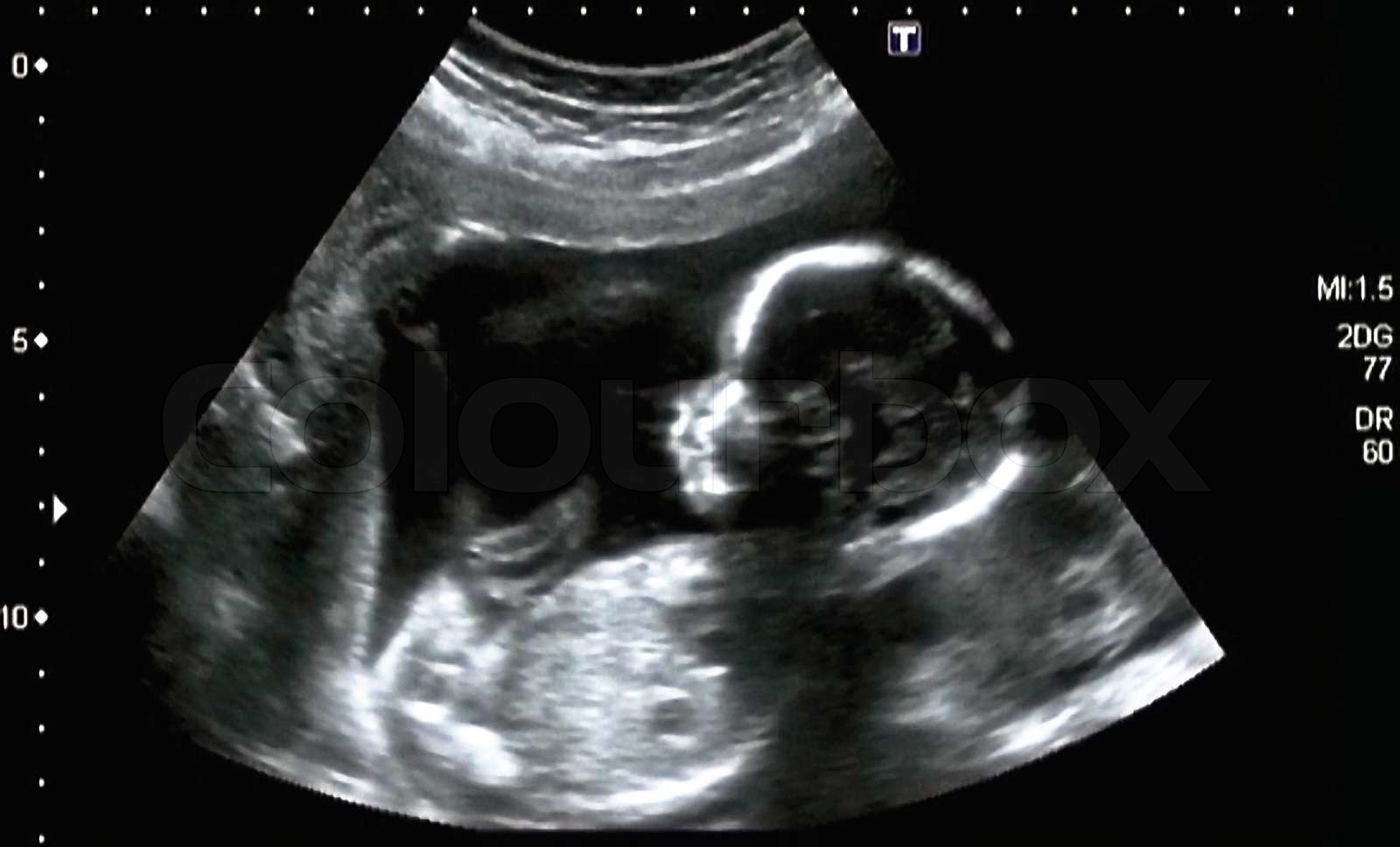 Ultrasonography Analysis of a 4th Month Fetus | Stock image | Colourbox
