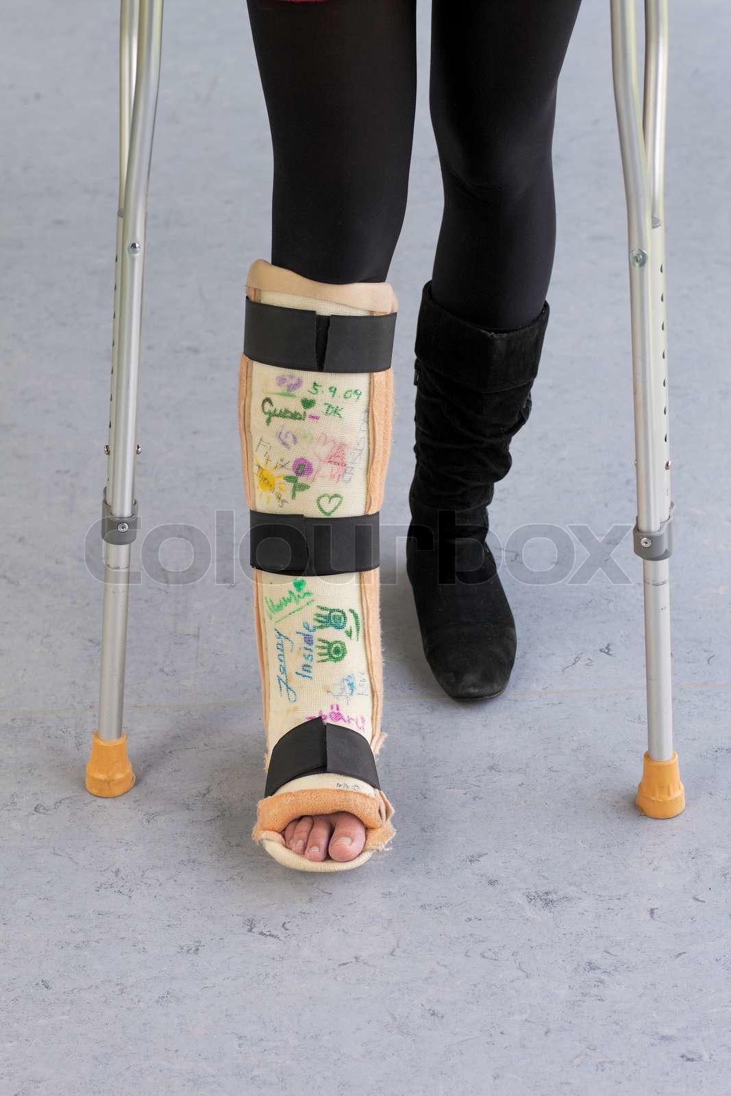 Young woman with leg cast | Stock image | Colourbox