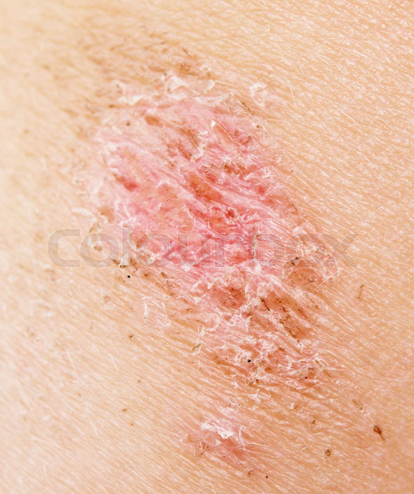 wound | Stock image | Colourbox