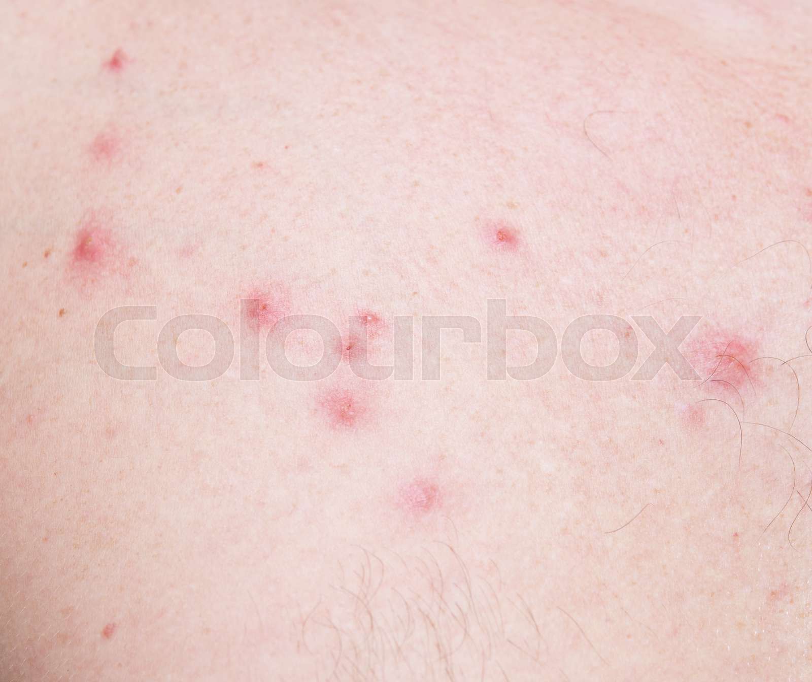 pimples | Stock image | Colourbox