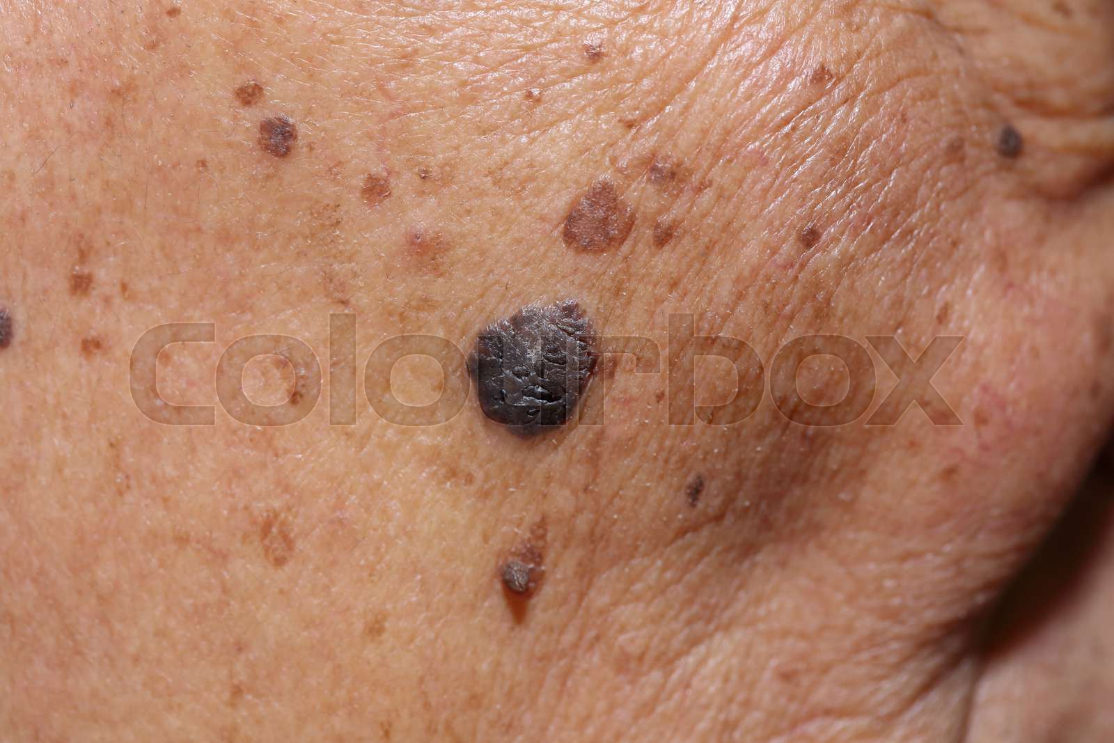 suspicious mole on skin | Stock image | Colourbox