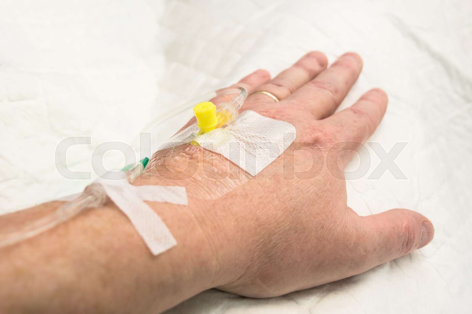 Infusion given into hand | Stock image | Colourbox
