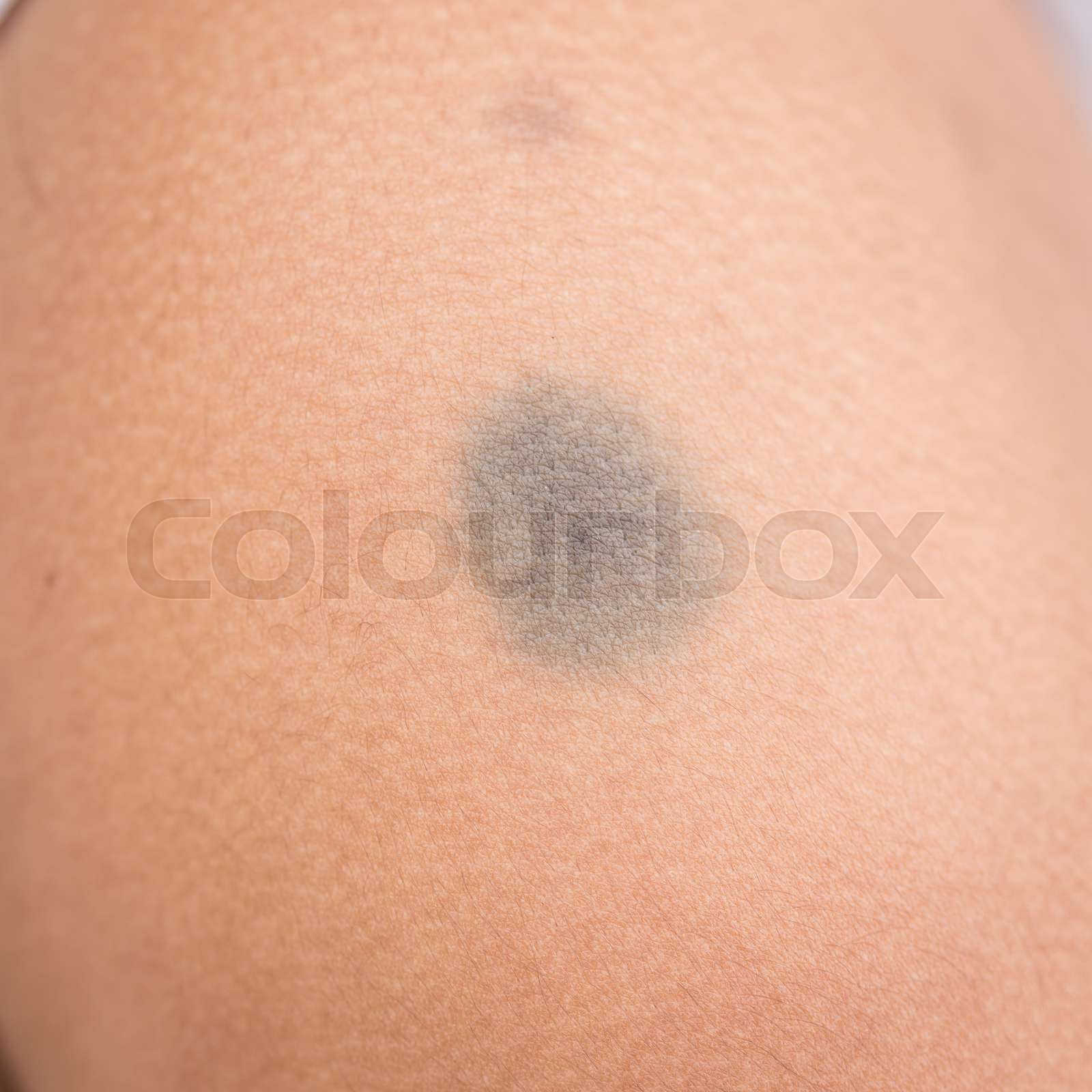 Birthmark on skin | Stock image | Colourbox