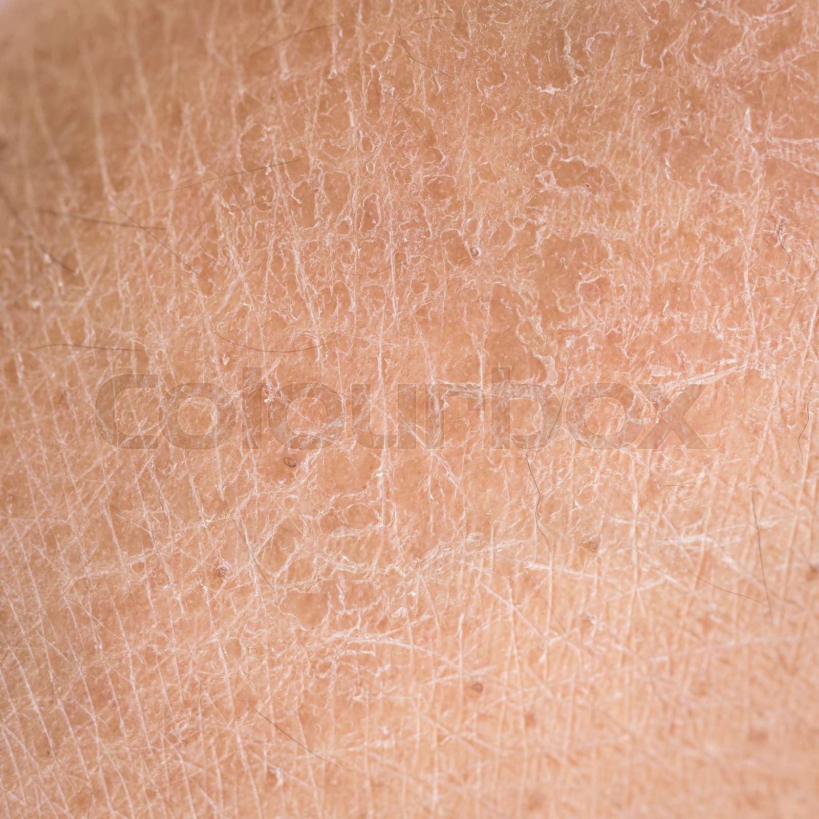 haut, trocken, hautausschlag | Stock Bild | Colourbox