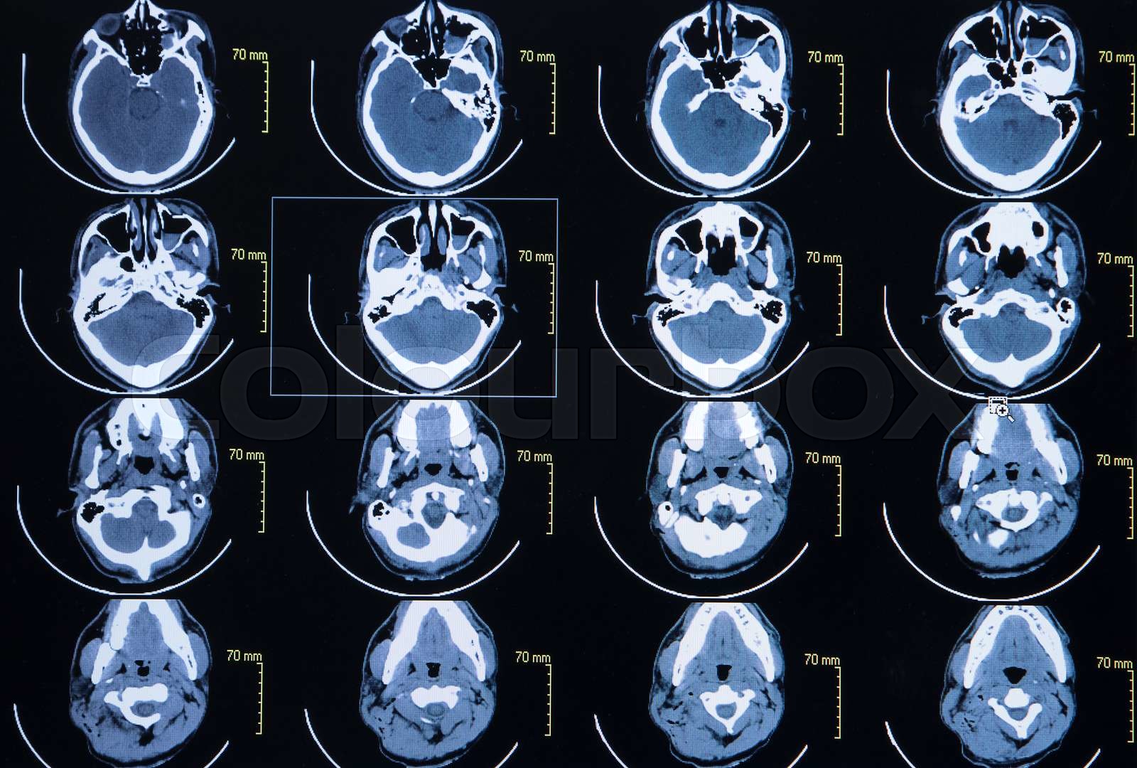 Series of images from a computerized tomography of the brain | Stock ...