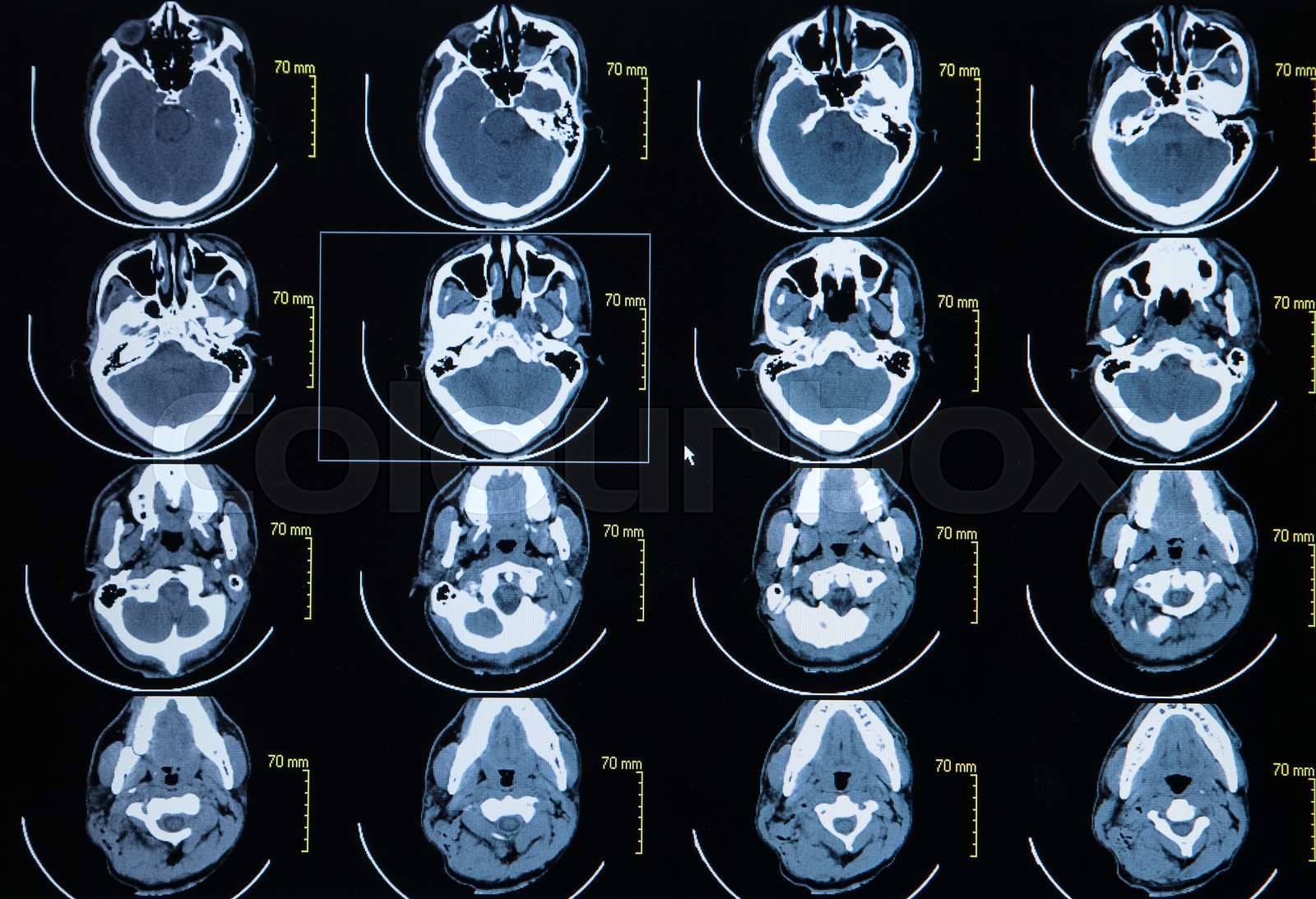 Series of images from a computerized tomography of the brain | Stock ...