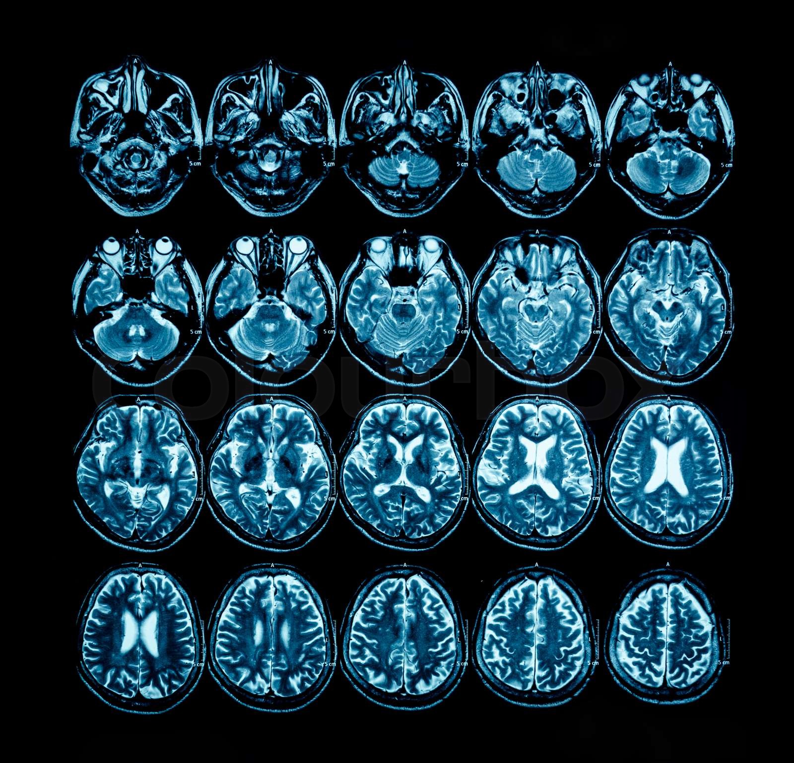 x-ray film of the brain computed tomography | Stock image | Colourbox