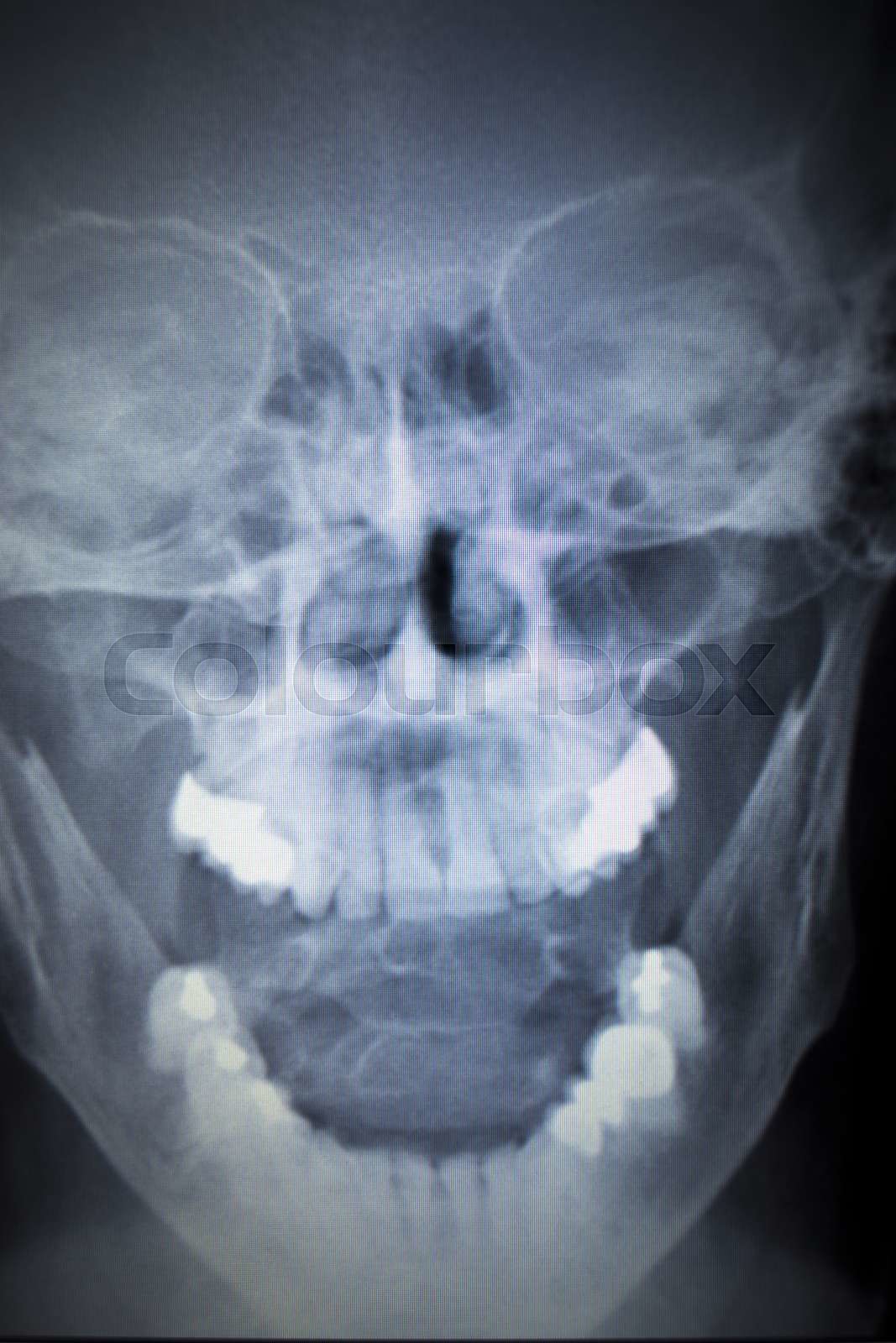 X-ray orthopedics Traumatology scan nose injury breathing | Stock image ...