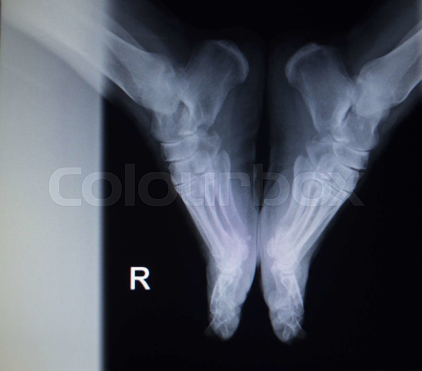 X-ray orthopedics scan of foot injury | Stock image | Colourbox