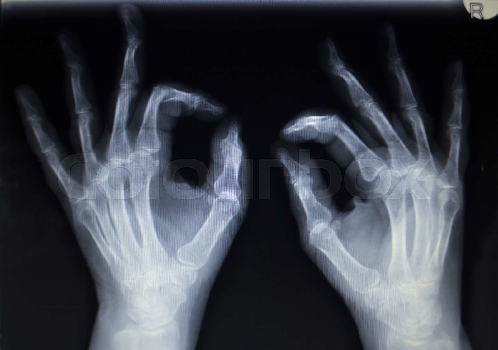 X-ray orthopedics Traumatology scan of hand finger injury | Stock image ...