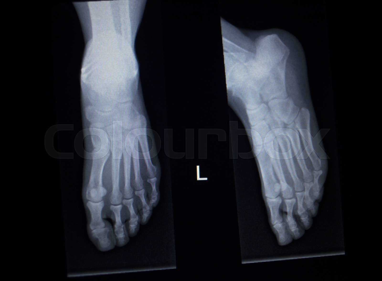 X-ray orthopedics scan of foot injury anterior posterior AP | Stock ...