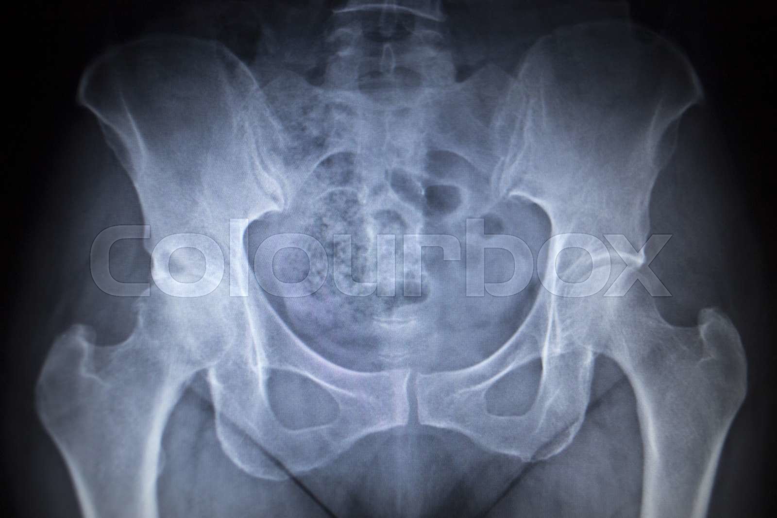 X-ray orthopedic scan image of hip joints human skeleton | Stock image ...