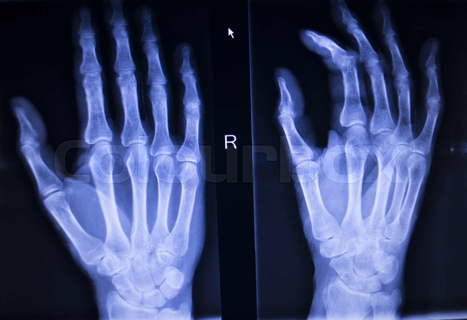 X-ray orthopedics Traumatology scan of hand finger injury | Stock image ...