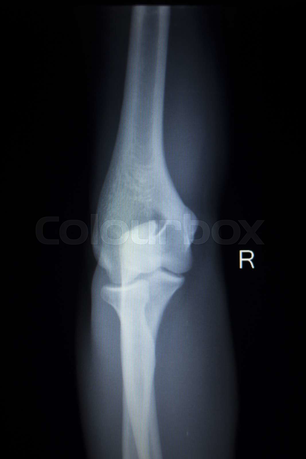 X-ray orthopedics Traumatology scan of elbow joint injury | Stock image ...
