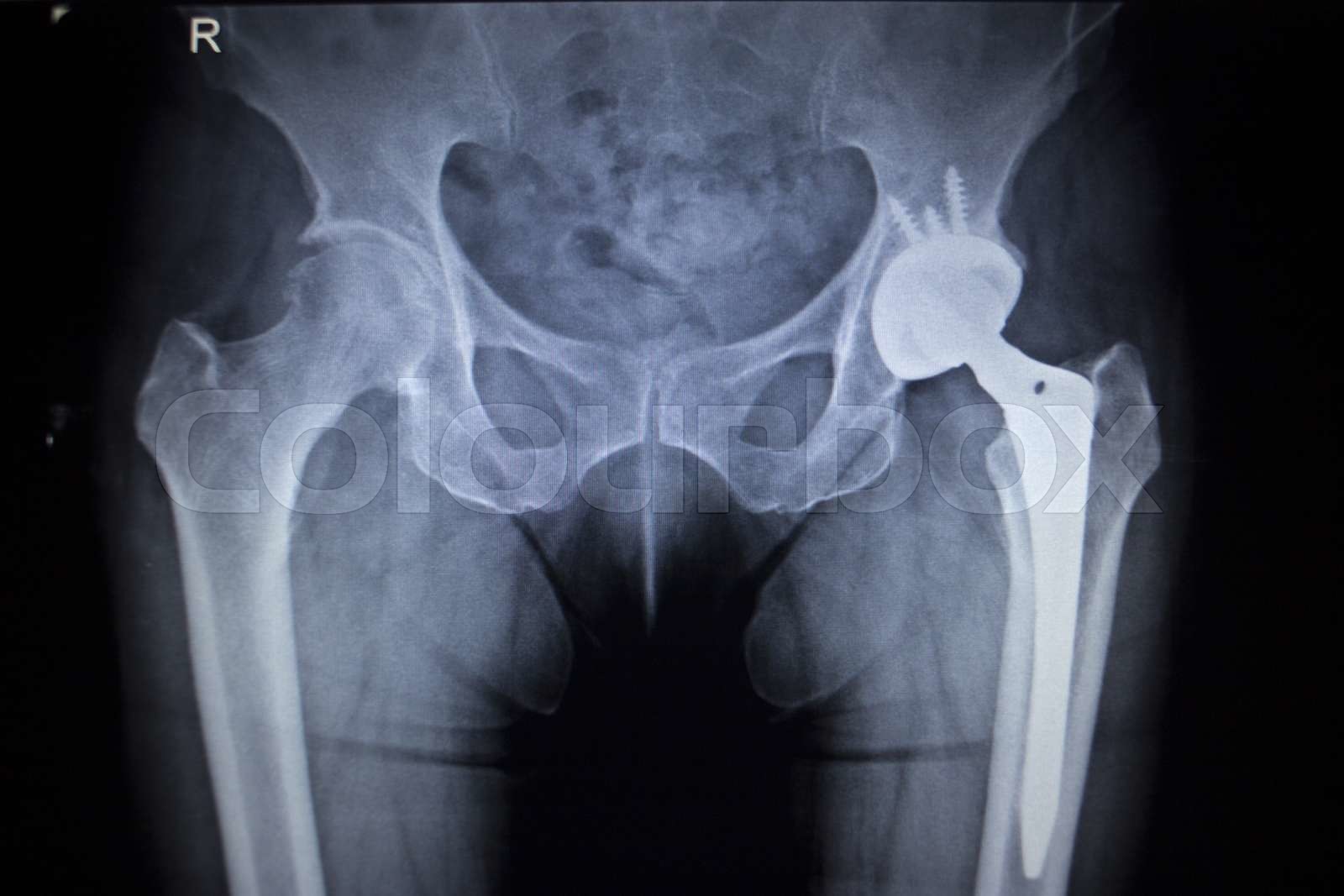 X-ray scan image of hip joint replacement orthopedic implant | Stock ...