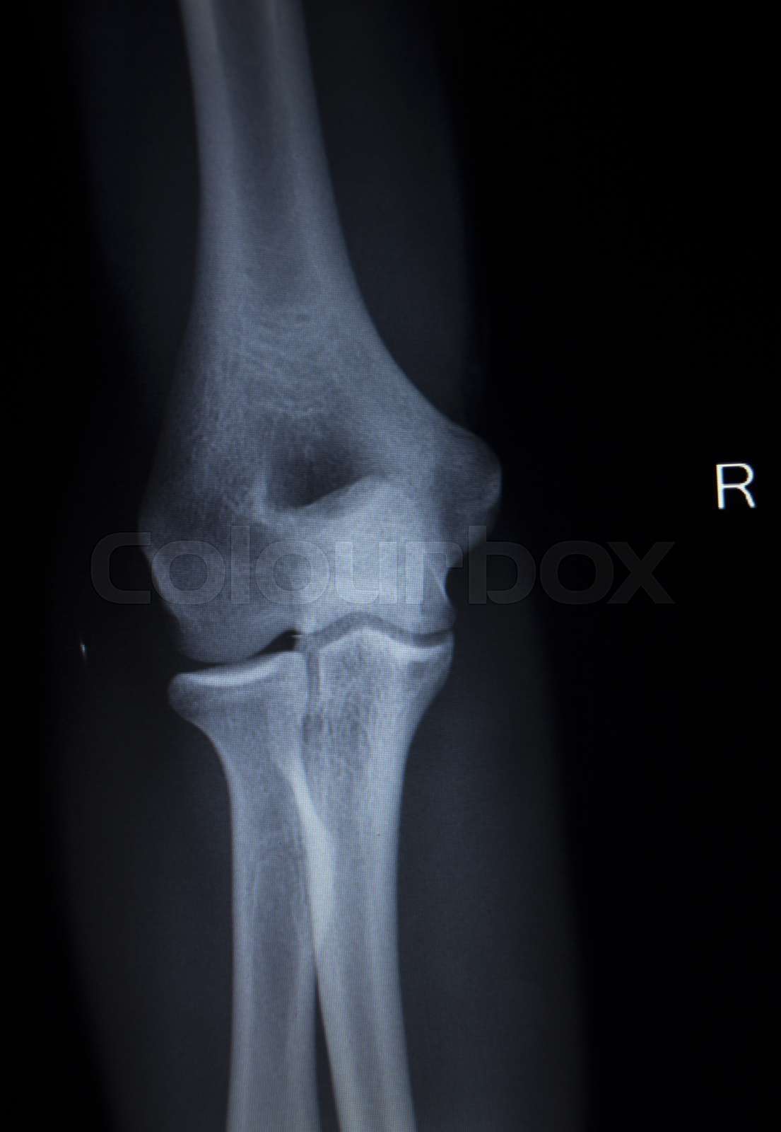 X-ray orthopedics Traumatology scan of elbow joint injury | Stock image ...