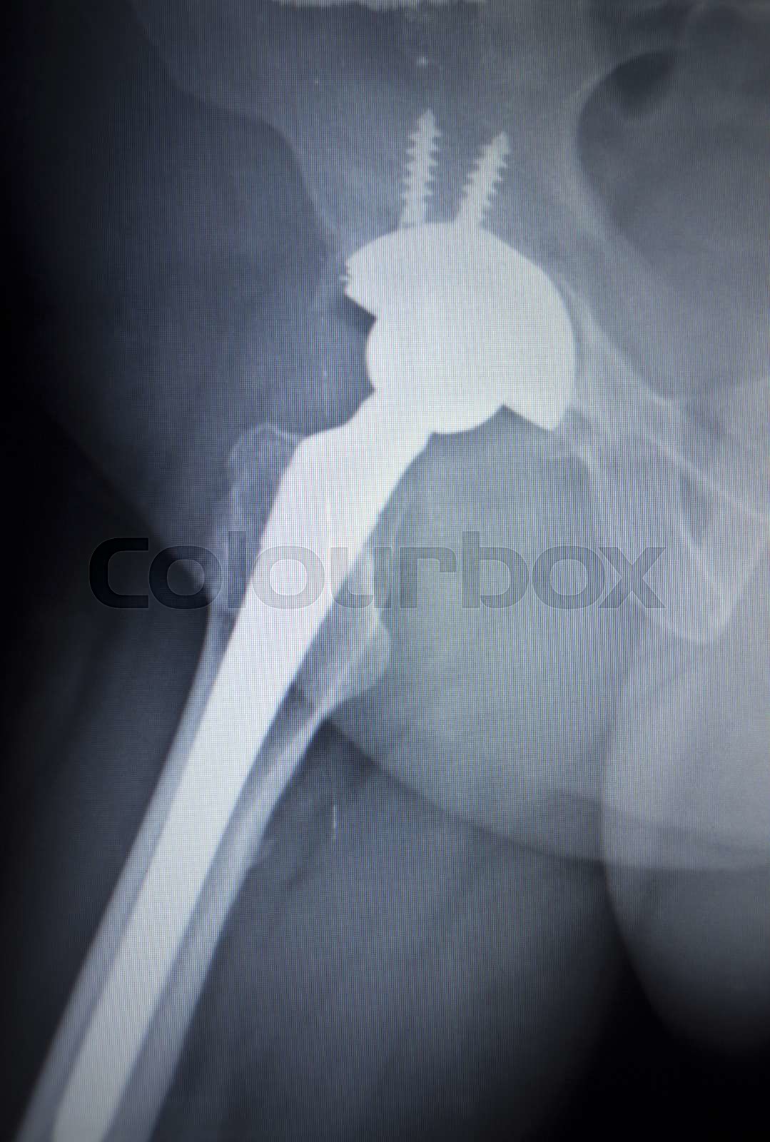 X-ray scan image of hip joint replacement orthopedic implant | Stock ...