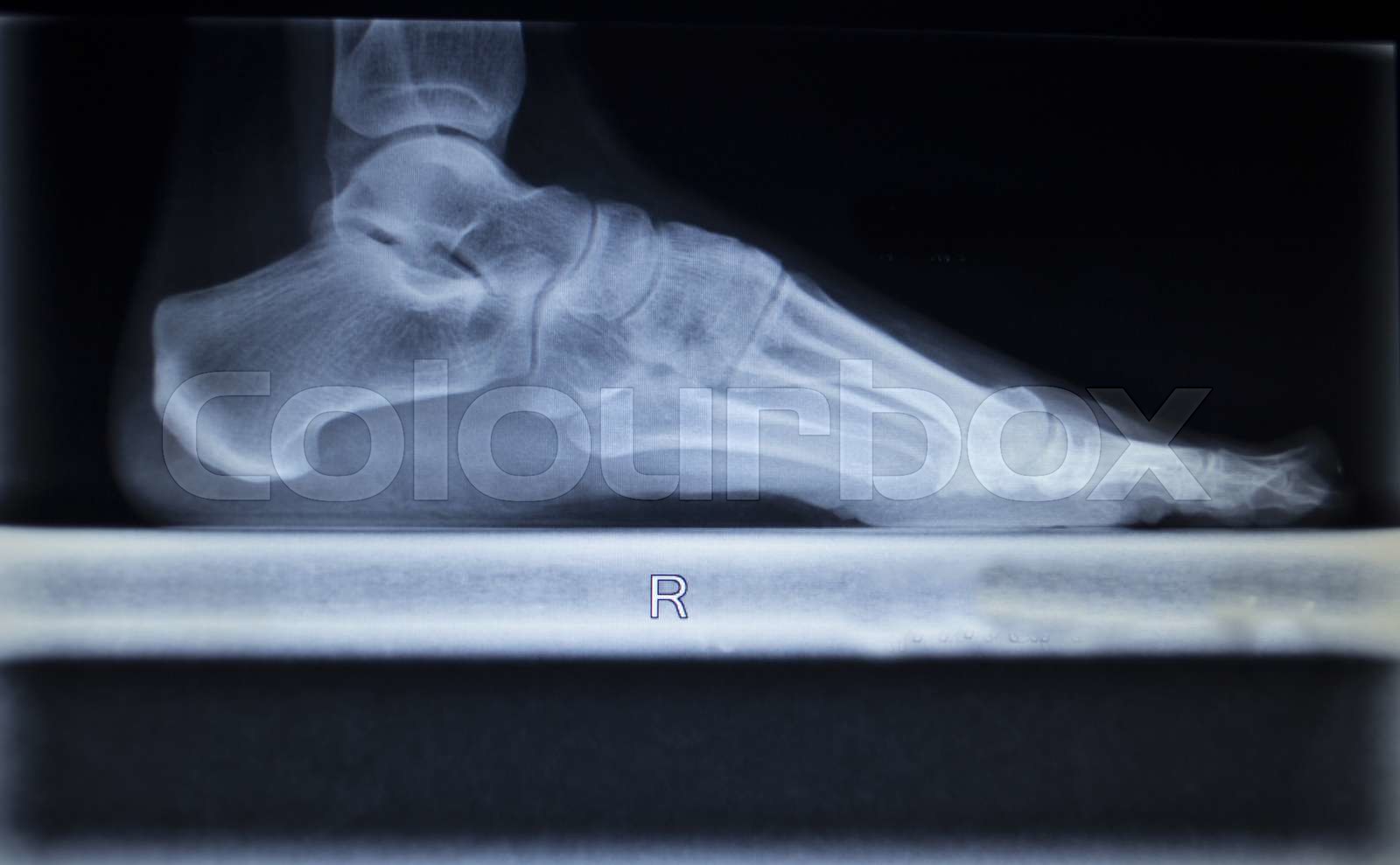 X-ray orthopedics scan of foot injury load weight bearing | Stock image ...