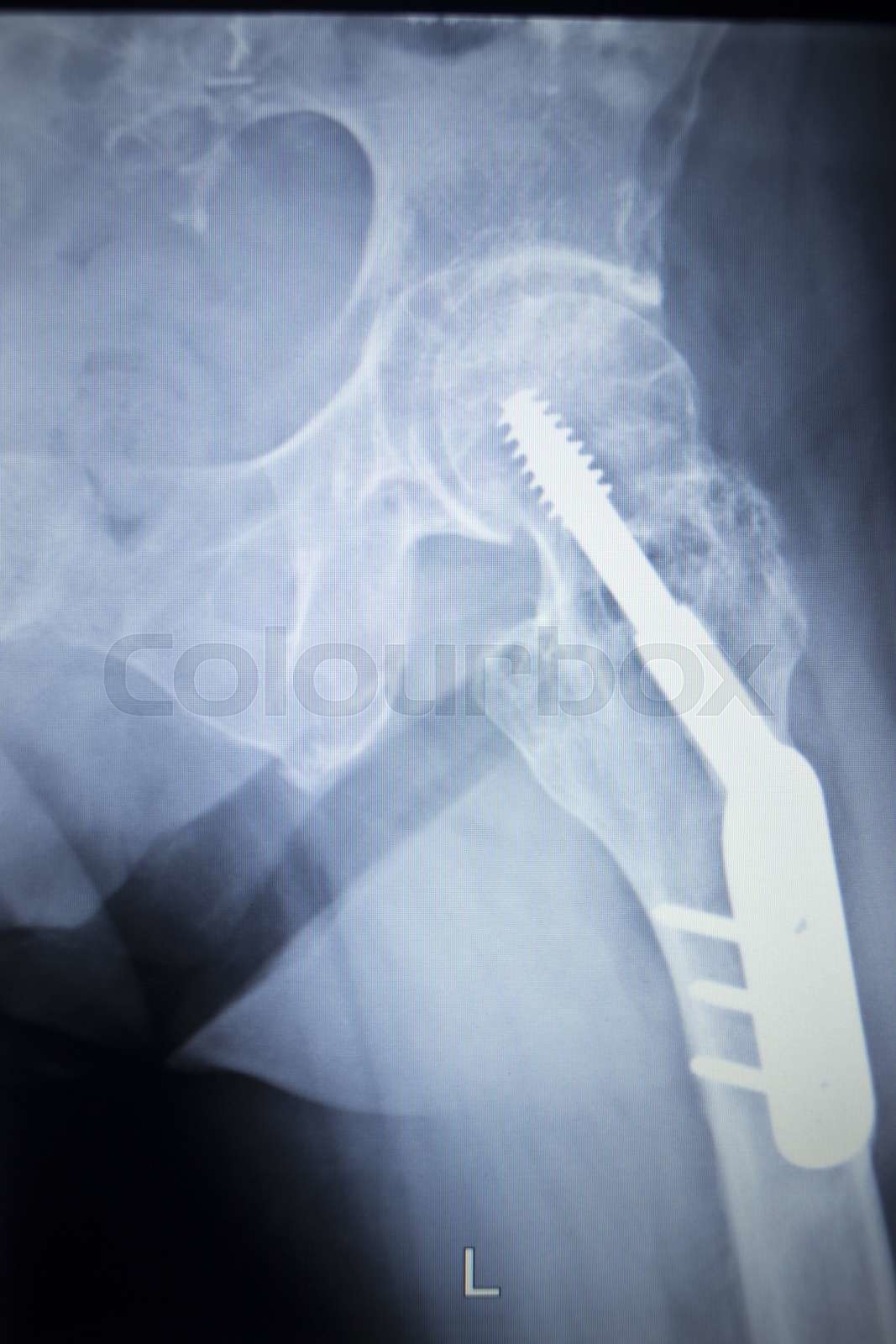 X-ray scan image of hip joint replacement orthopedic implant | Stock ...
