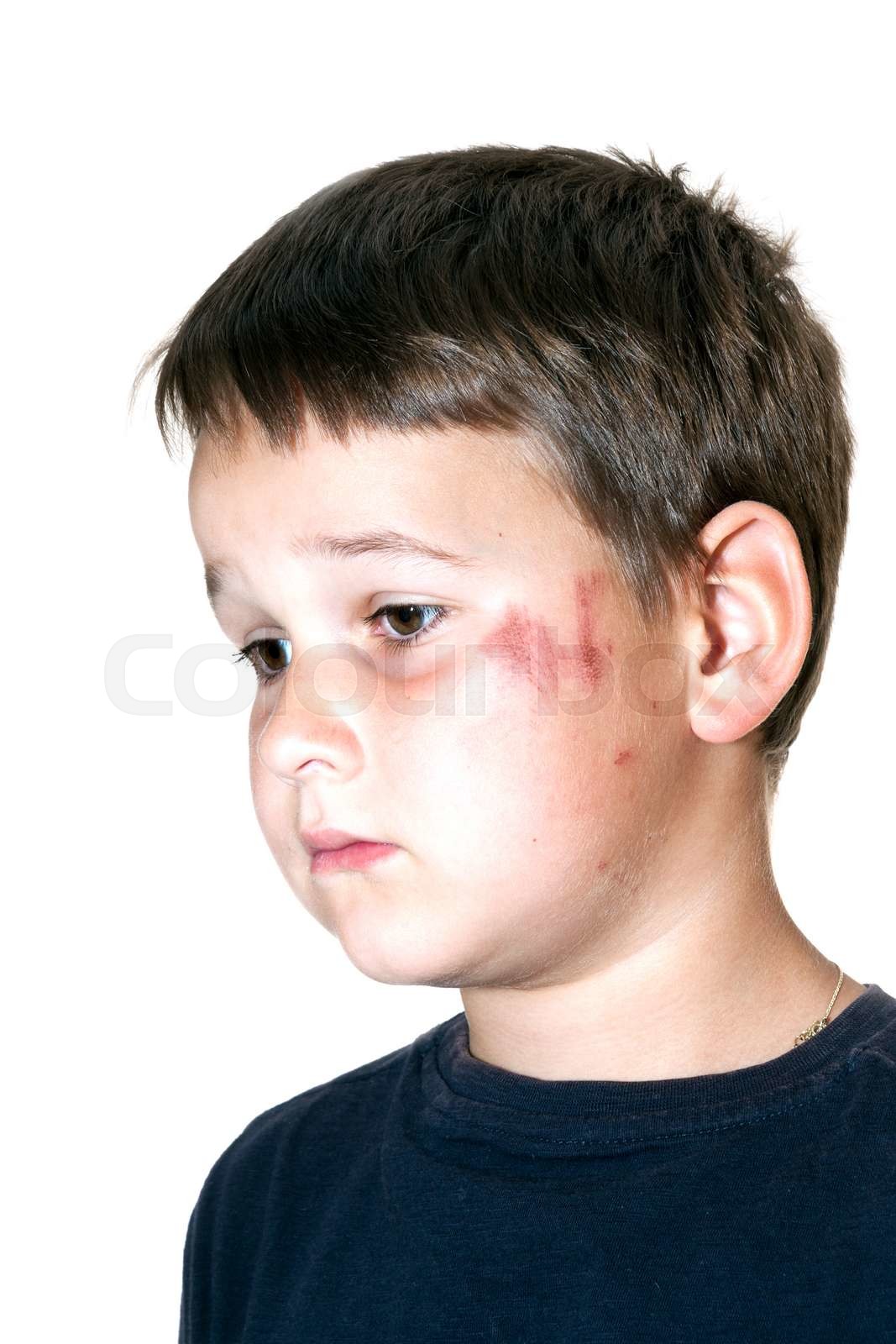 sad boy with a scraped face | Stock image | Colourbox