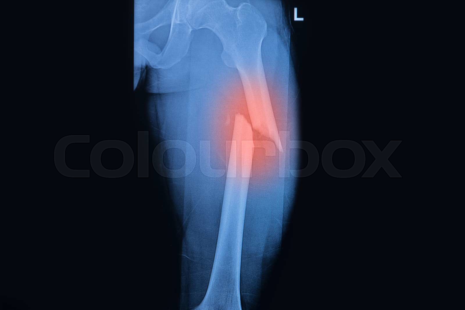 Fractured Femur, Broken thigh x-rays image | Stock image | Colourbox