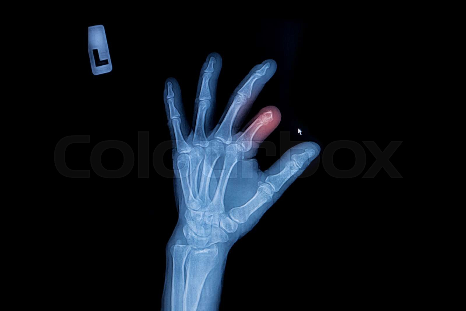 X-ray of trauma hand and finger | Stock image | Colourbox