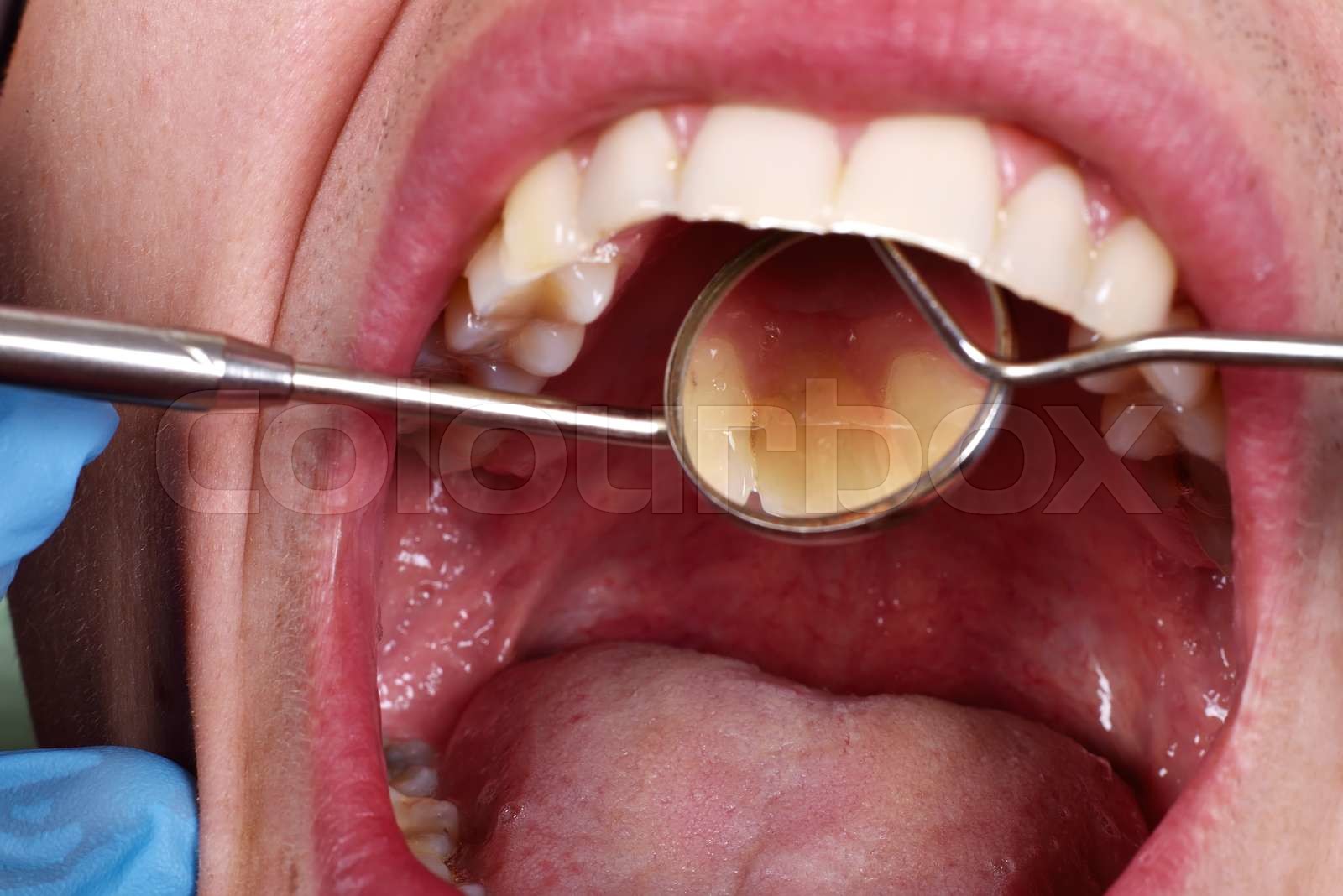 patient open mouth | Stock image | Colourbox