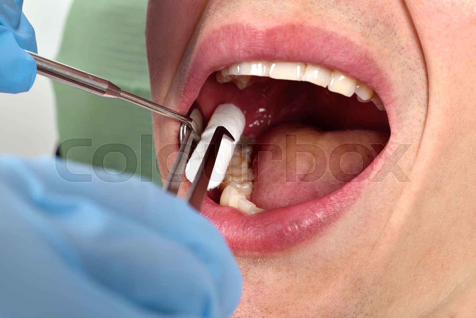 The dentist inserts the swab | Stock image | Colourbox