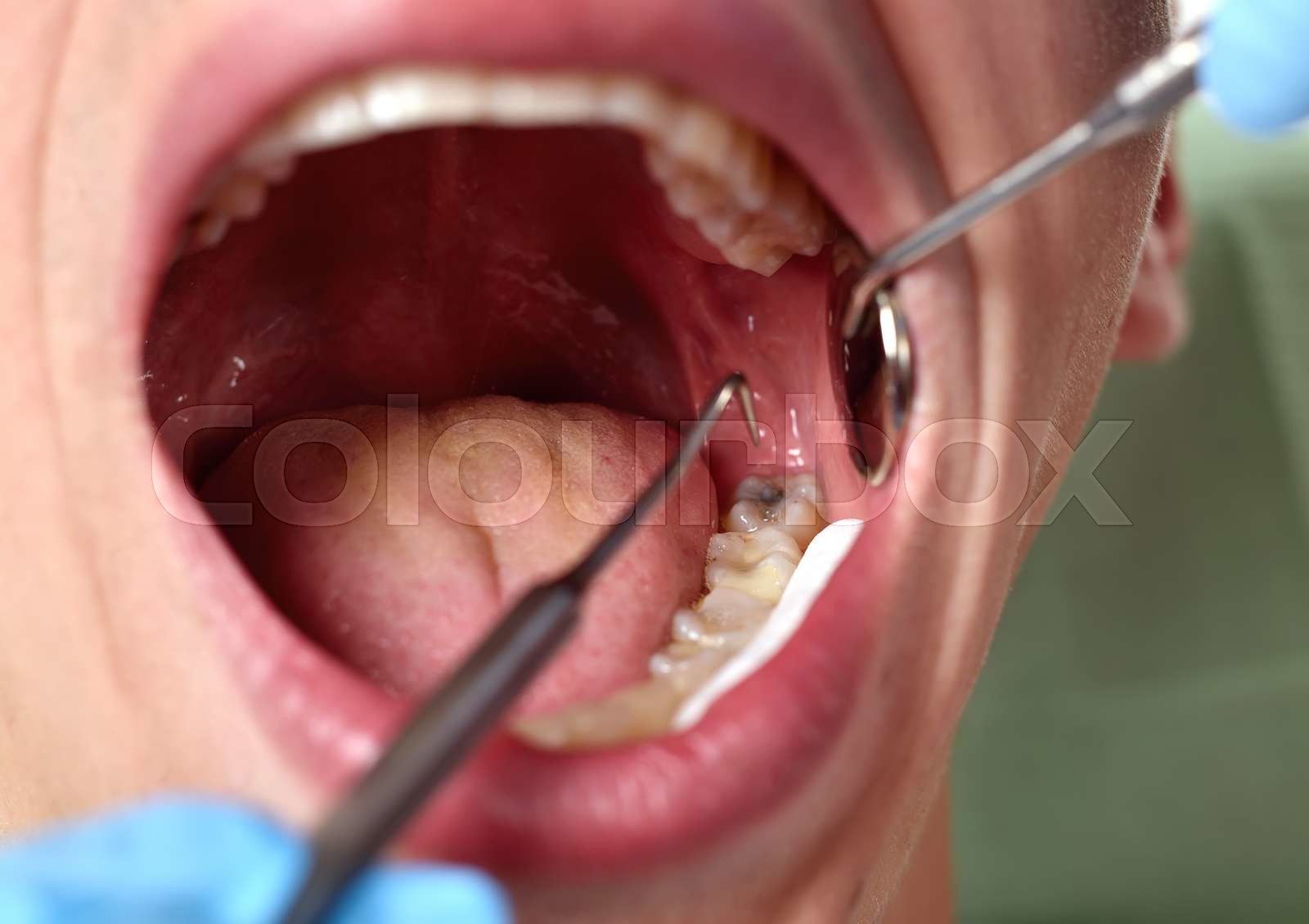 patient open mouth | Stock image | Colourbox