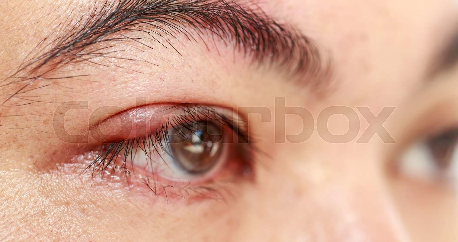 Right upper eye lid abscess "stye or hordeolum" | Stock image | Colourbox